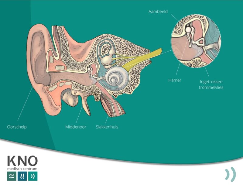fors ingetrokken trommelvlies - KNO MEDISCH CENTRUM
