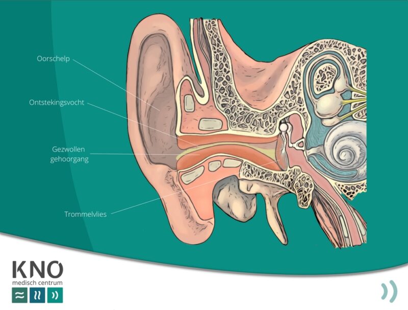 gehoorgangontsteking (otitis externa) - KNO MEDISCH CENTRUM