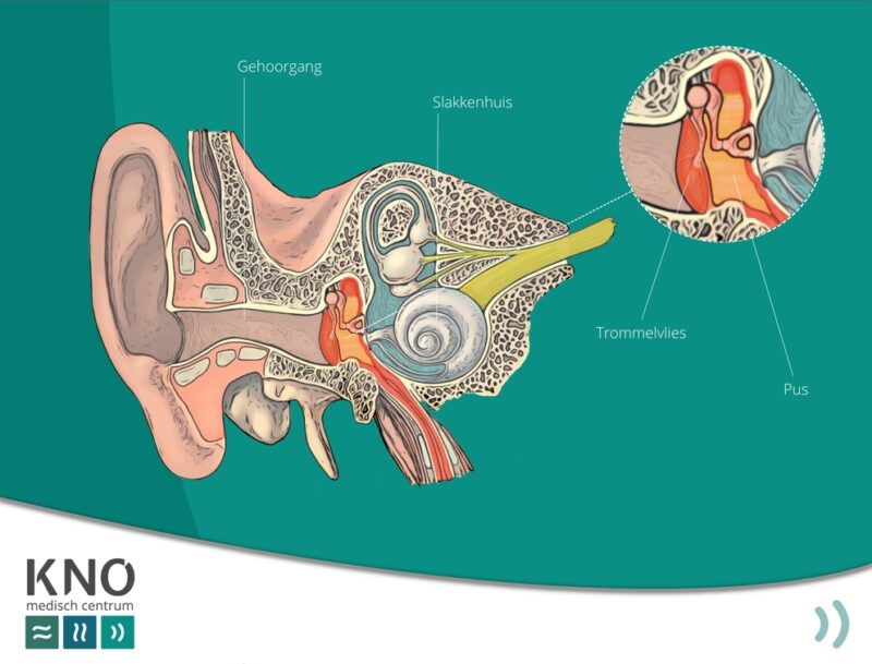 middenoorontsteking - KNO MEDISCH CENTRUM