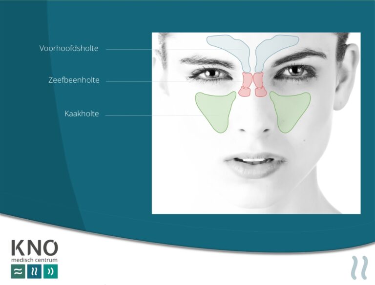 neusbijholte ontsteking - KNO MEDISCH CENTRUM