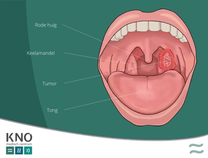 keelkanker (tumor in de keel) - KNO MEDISCH CENTRUM