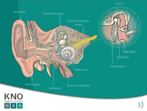 trommelvliesontsteking (myringitis) - KNO MEDISCH CENTRUM
